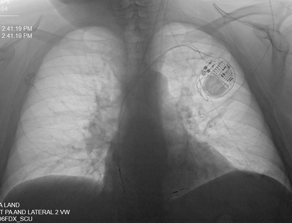 Pacemakers Get an Upgrade | Mercy