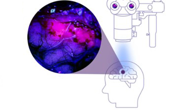 Mercy South Adds Fluorescence-Guided Brain Tumor Surgery | Mercy